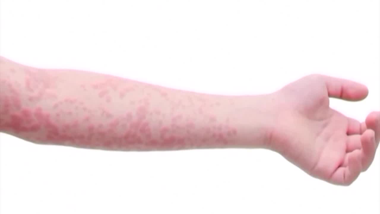 Once-eradicated measles virus on the rise in Ohio – Fox 8 Cleveland WJW