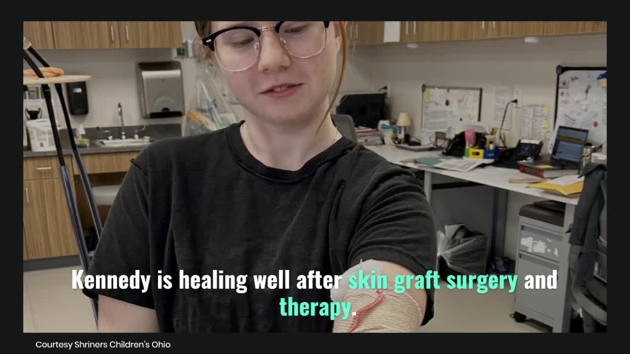 Ohio teen burned badly using nail polish remover near candle – Fox 8 ...