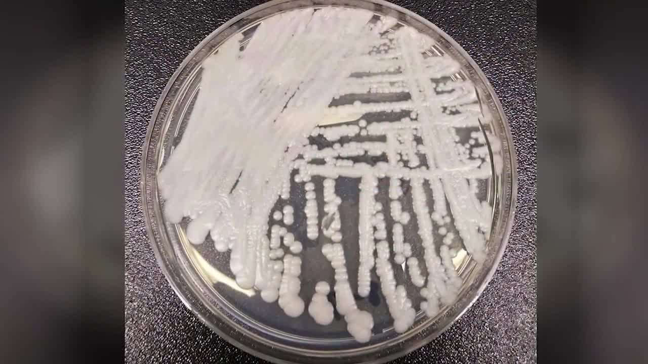 Where deadly fungus cases have surfaced in NE Ohio – Fox 8 Cleveland WJW